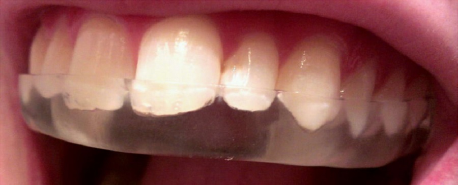 Side Effects of Teeth Grinding: Damage, Sleep Loss & More | Fortson ...